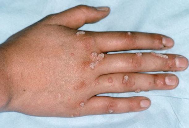 EndWarts - ein effektives Mittel gegen Warzen und Dornwarzen