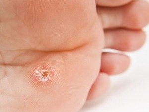 Warzenarten im Überblick – welche Warze haben Sie?