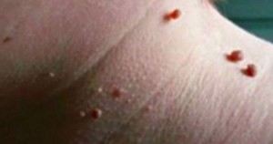 Warzenarten im Überblick – welche Warze haben Sie?