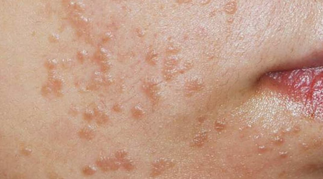 Dornwarzen vereisen – sehr wirksam bei korrekter Anwendung