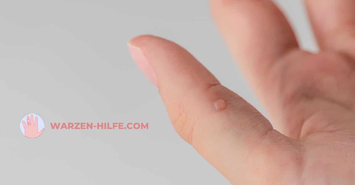 Produkte gegen Warzen effektive Lösungen zur Warzenentfernung